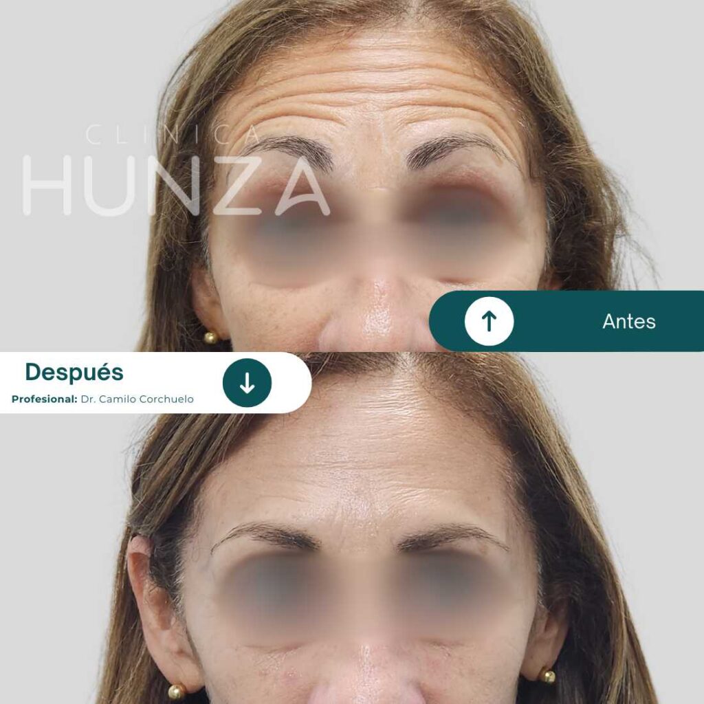 Infiltración de Toxina Botulinica (Botox) 2 y 3 zonas - Clínica Hunza