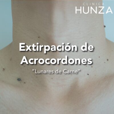 Extirpación Acrocordones - Clínica Hunza